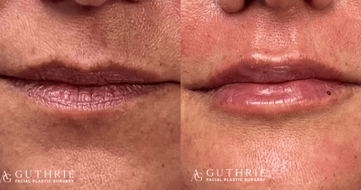 Facial Fat Grafting vs. Fillers: Which Is Right for You? - Reaper Scans